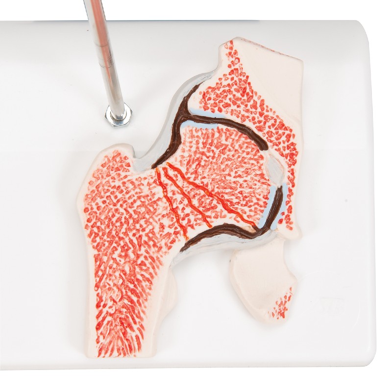 Hip Model w/ Fracture and Osteoarthritis | Health and Care